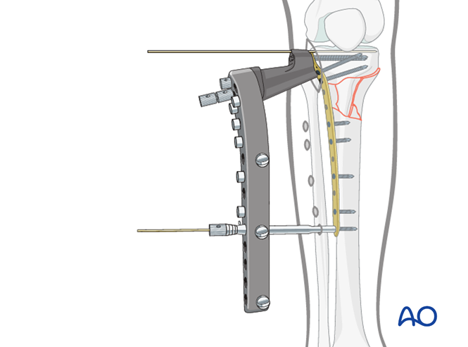 MIO - Angular stable plate (LISS) for Extraarticular fracture ...