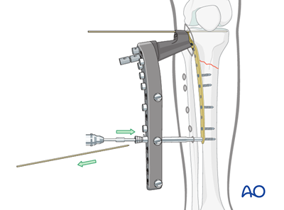 MIO - Angular stable plate (LISS) for Extraarticular fracture ...