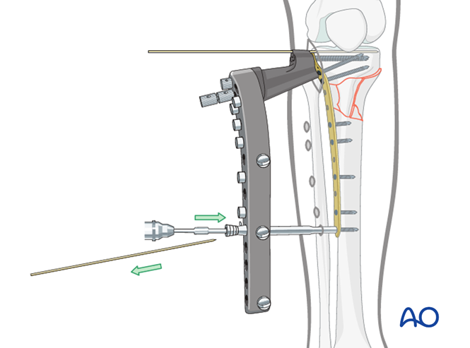 MIO - Angular stable plate (LISS) for Extraarticular fracture ...