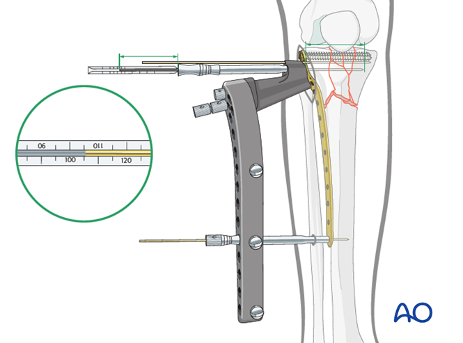 MIO - Angular stable plate (LISS) for Complete articular fracture ...