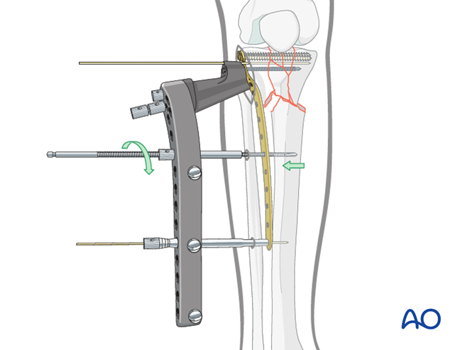 MIO - Angular stable plate (LISS) for Complete articular fracture ...