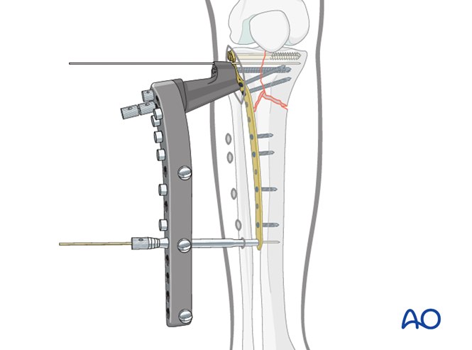 MIO - Angular stable plate (LISS) for Complete articular fracture ...