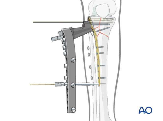 MIO - Angular stable plate (LISS) for Complete articular fracture ...