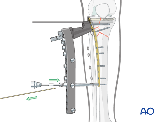 MIO - Angular stable plate (LISS) for Complete articular fracture ...