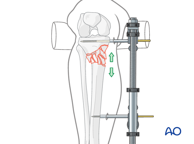 MIO - Angular stable plate (LISS) for Extraarticular fracture ...