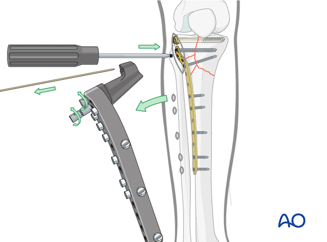 MIO - Angular stable plate (LISS) for Complete articular fracture ...