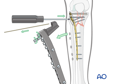 MIO - Angular stable plate (LISS) for Complete articular fracture ...