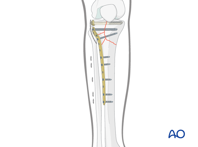 MIO - Angular stable plate (LISS) for Complete articular fracture ...