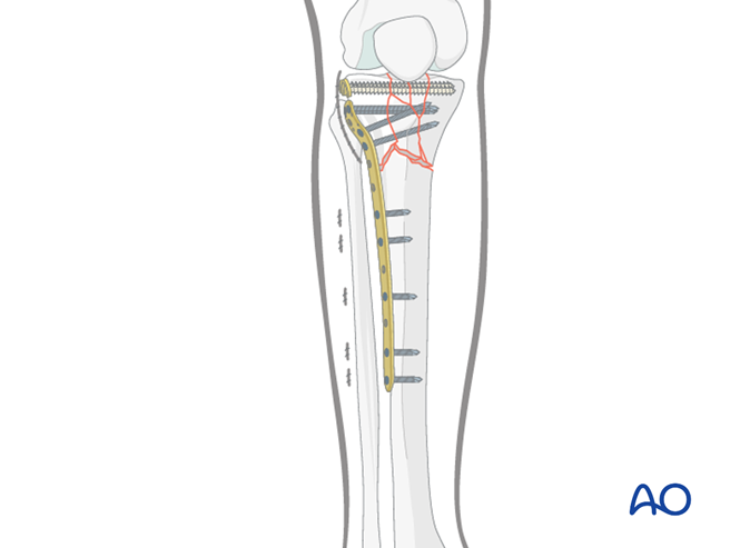 MIO - Angular stable plate (LISS) for Complete articular fracture ...