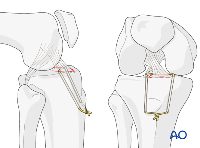 Wire fixation for Extraarticular fracture, avulsion of tibial spine