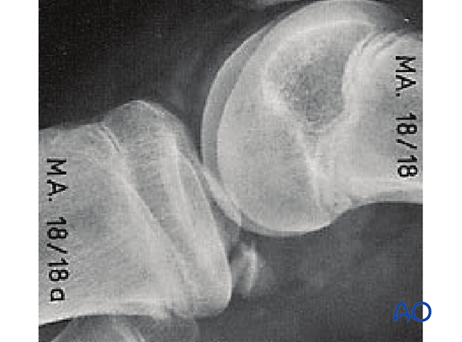 Extraarticular fracture, avulsion of tibial spine or capsular attachments