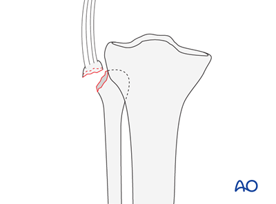 Extraarticular fracture, avulsion of fibular head
