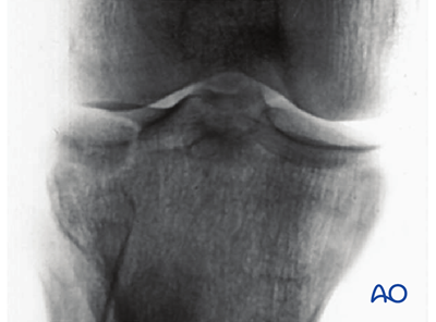 Partial articular fracture, split