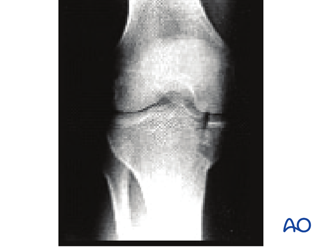 Partial articular fracture, split