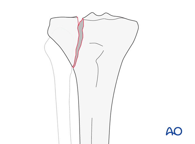 Partial articular fracture, split