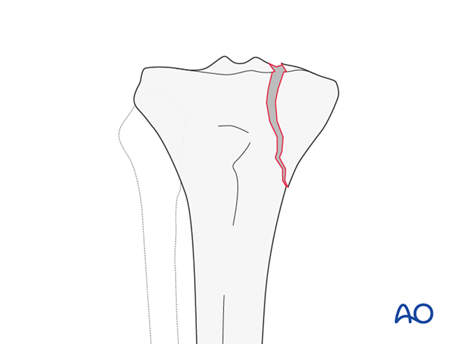 Partial articular fracture, split
