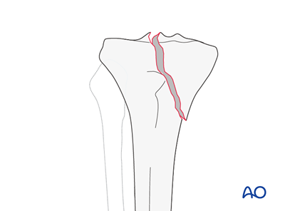 Partial articular fracture, split