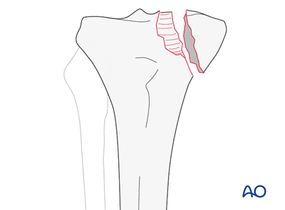 Partial articular fracture, split-depression