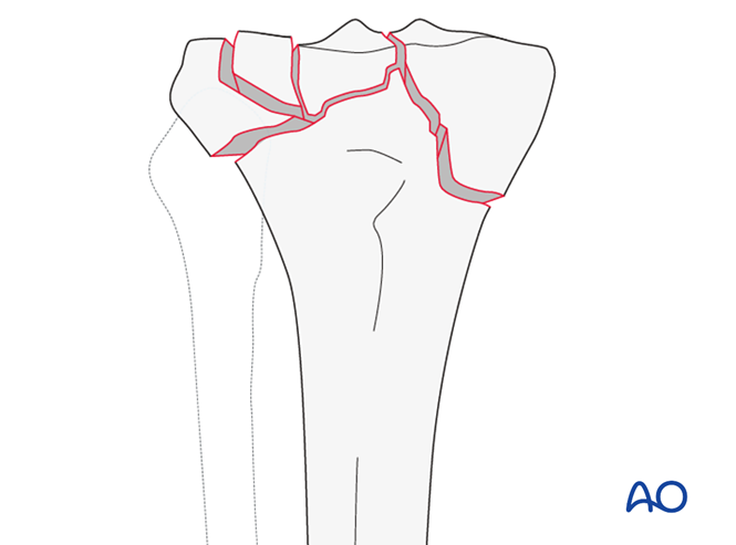 Complete articular fracture, fragmentary articular