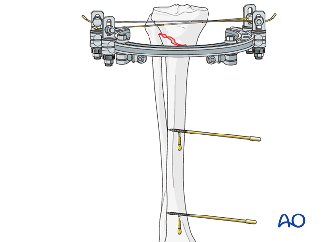 Ring external fixator (definitive) for Extraarticular fracture ...