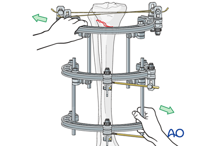 Ring external fixator (definitive) for Extraarticular fracture ...