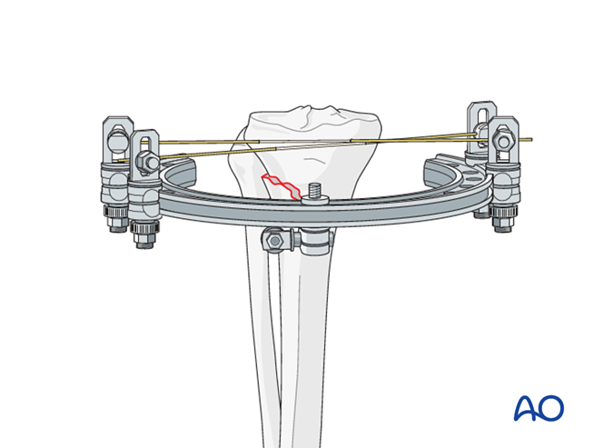 Ring external fixator (definitive) for Extraarticular fracture ...