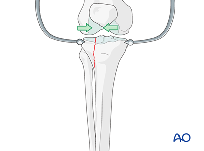 Ring external fixator (definitive) for Partial articular fracture, split