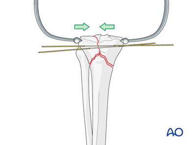 Ring external fixator (definitive) for Complete articular fracture ...