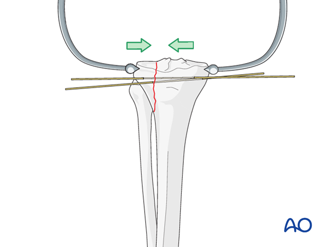 Ring external fixator (definitive) for Partial articular fracture, split