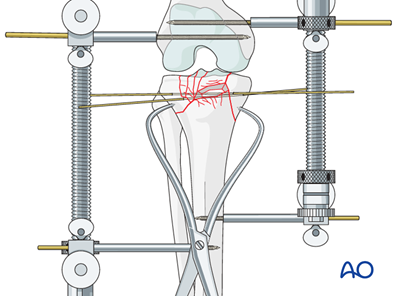 Ring external fixator (definitive) for Complete articular fracture ...