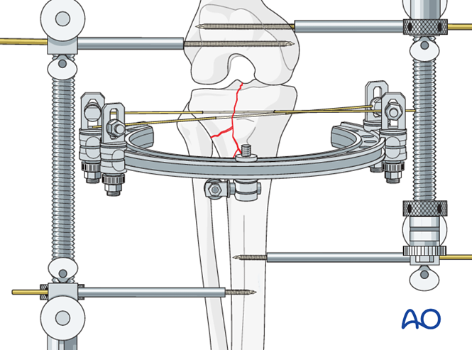 Ring external fixator (definitive) for Complete articular fracture ...