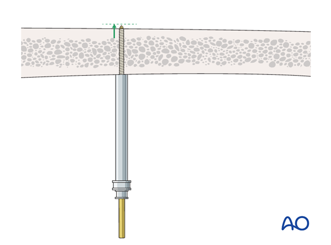 Safe zones in the tibia for pin placement