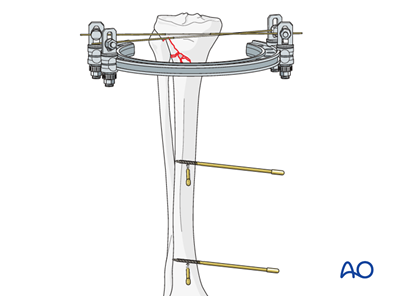 Ring external fixator (definitive) for Extraarticular fracture ...