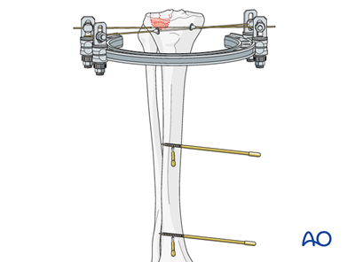 Ring external fixator (definitive) for Partial articular fracture ...
