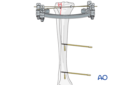 Ring external fixator (definitive) for Partial articular fracture ...