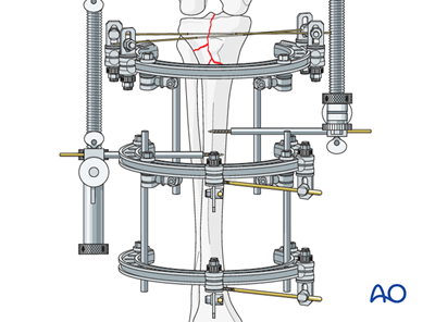 Ring external fixator (definitive) for Complete articular fracture ...