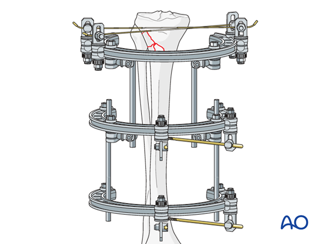 Ring external fixator (definitive) for Extraarticular fracture ...