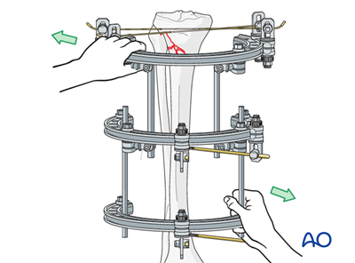 Ring external fixator (definitive) for Extraarticular fracture ...