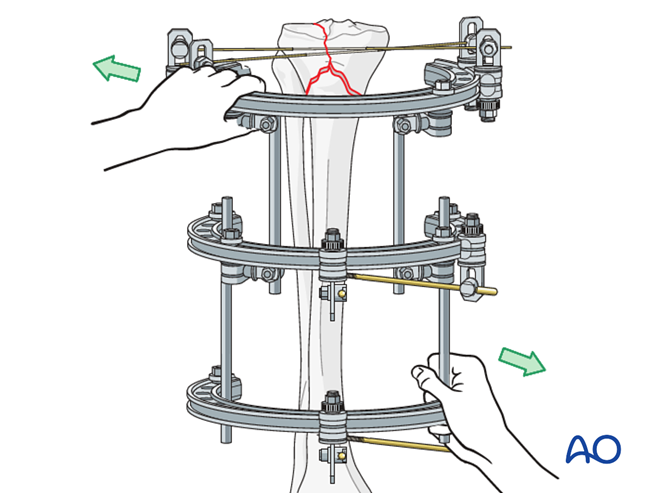 Ring external fixator (definitive) for Complete articular fracture ...