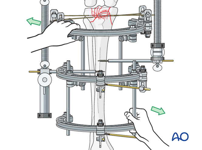 Ring external fixator (definitive) for Complete articular fracture ...