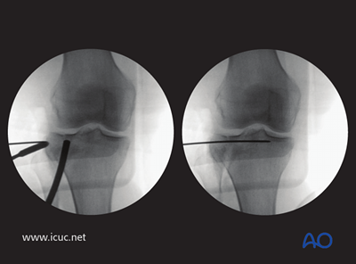 ORIF - Plates without angular stability for Partial articular fracture ...