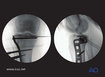 ORIF - Plates without angular stability for Partial articular fracture ...