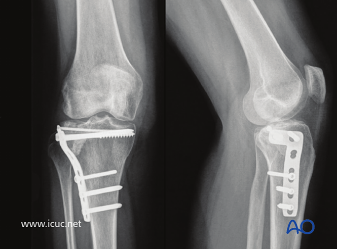 ORIF - Plates without angular stability for Partial articular fracture ...