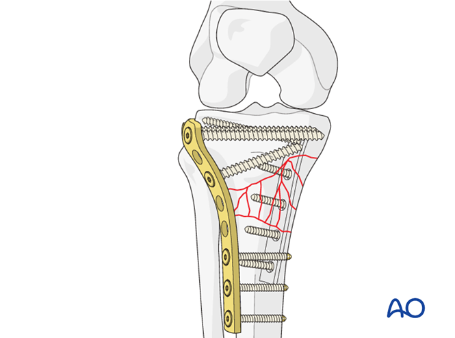 ORIF - Plates without angular stability for Extraarticular fracture ...