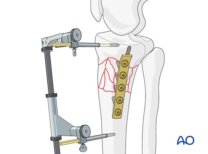 ORIF - Plates without angular stability for Extraarticular fracture ...