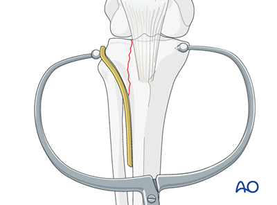 ORIF - Plates without angular stability for Partial articular fracture ...