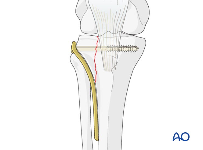 ORIF - Plates without angular stability for Partial articular fracture ...