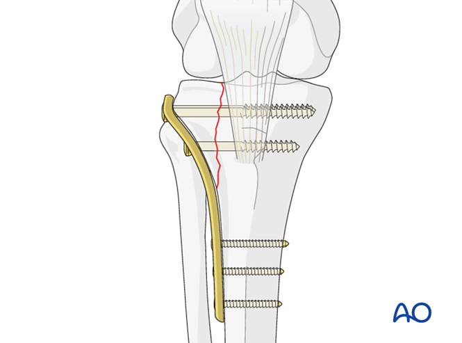 ORIF - Plates without angular stability for Partial articular fracture ...