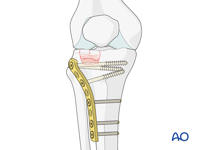 ORIF - Plates without angular stability for Partial articular fracture ...