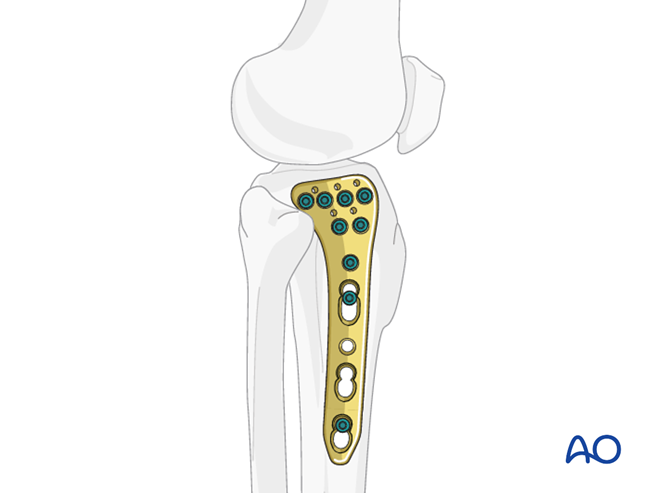 ORIF - Plates without angular stability for Partial articular fracture ...